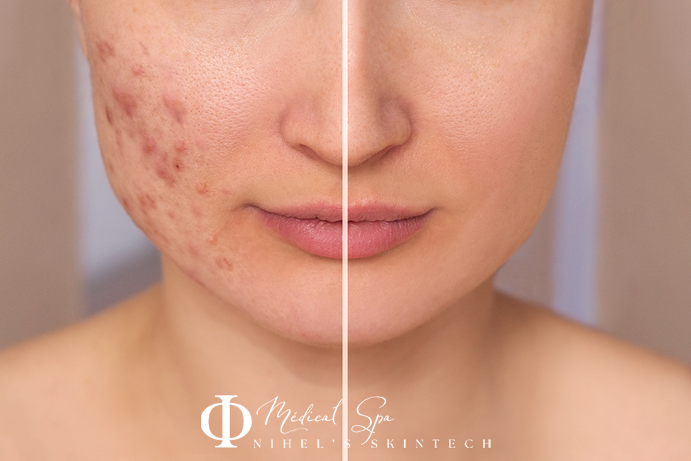 Traitement Adieu Acné | Nihel's Skintech